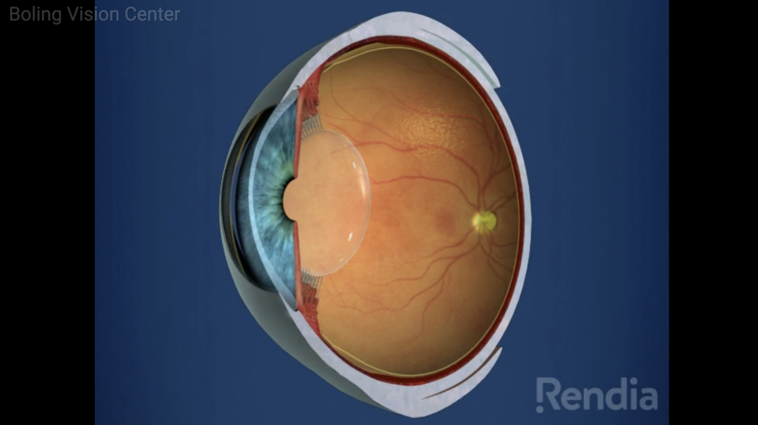 CLE Surgery - Clear Lens Exchange | Boling Vision Center, Elkhart